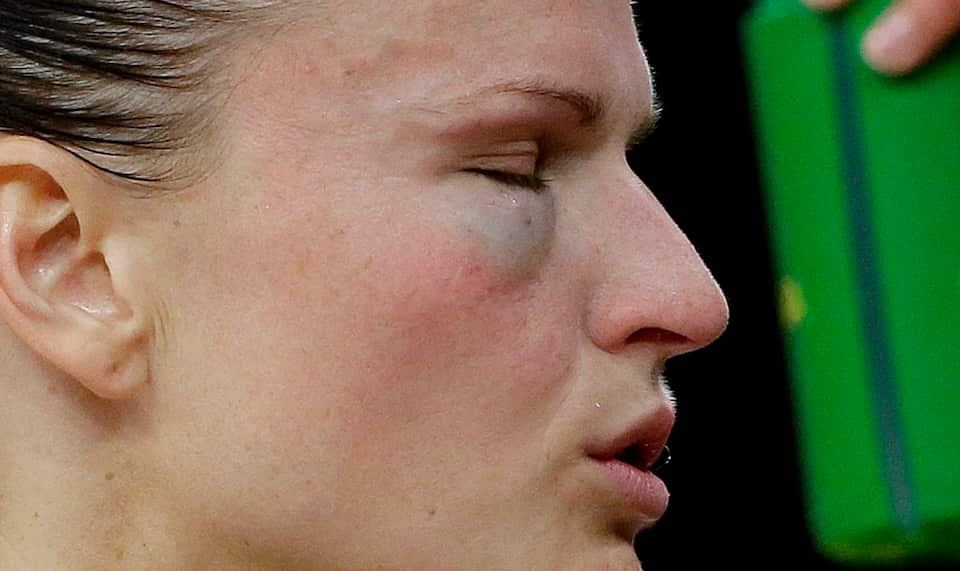Why do I bruise so easily and is it something serious? | SBS News