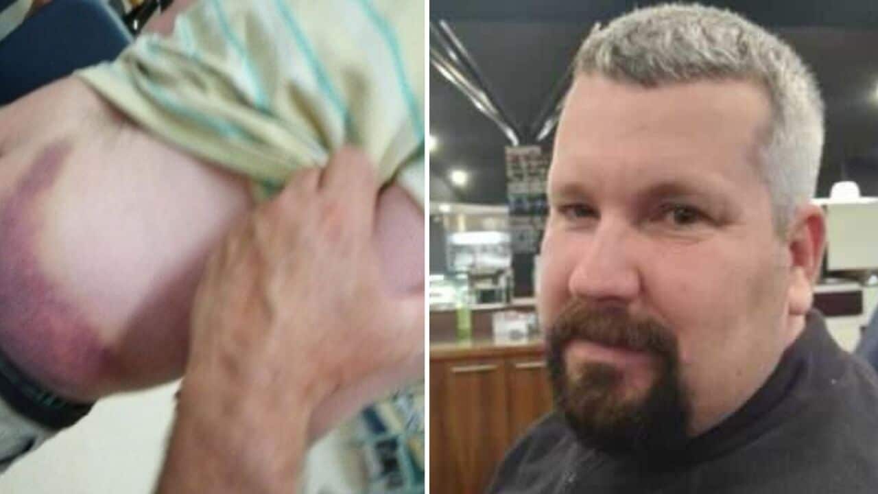 internal bleeding bruise