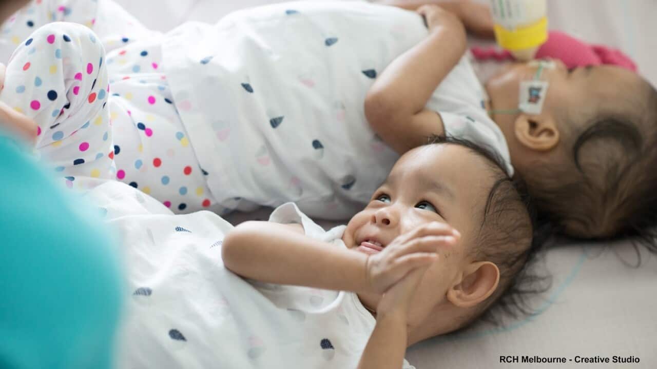 First photos of separated twins show they're as close as ever | SBS News