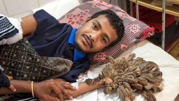 Tree Man Abul Bajandar Regains The Use Of His Hands After 16