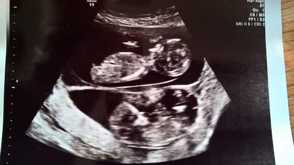 A pair of semi-identical twins born in Queensland have made history ...